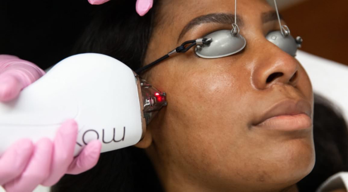 Rejuvenate with Sciton Moxi Laser - Estetica Medspa